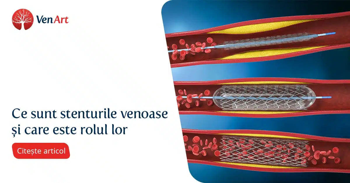 Stentarea Venoasa sau Angioplastia Venoasa - Clinica VenArt