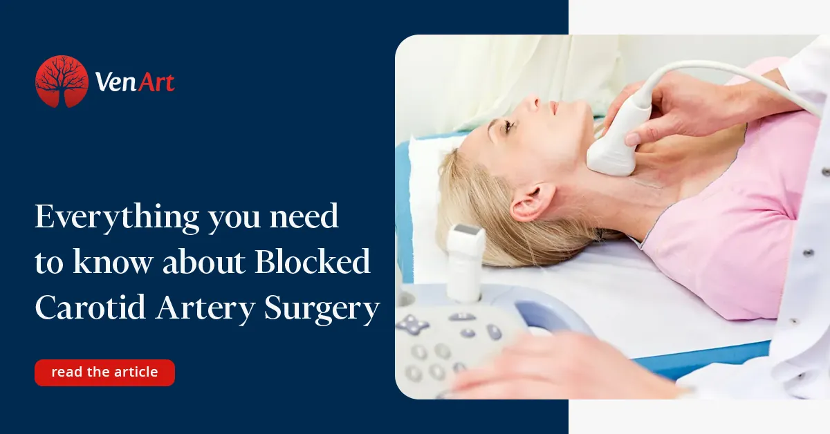 Blocked Carotid Artery Surgery: Everything you need to know