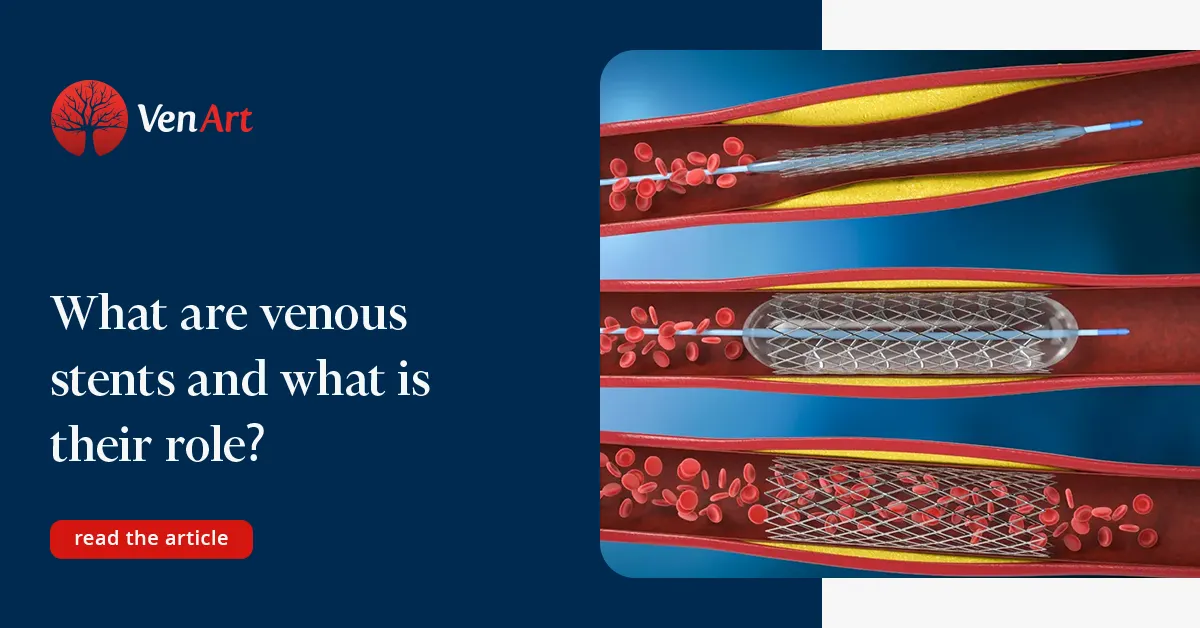 Venous Stenting or Venous Angioplasty | VenArt Clinic