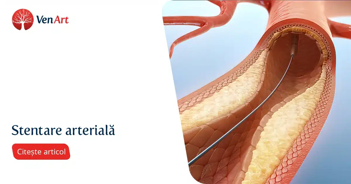 Stentare Arteriala: Revascularizare prin Chirurgie Endovasculara