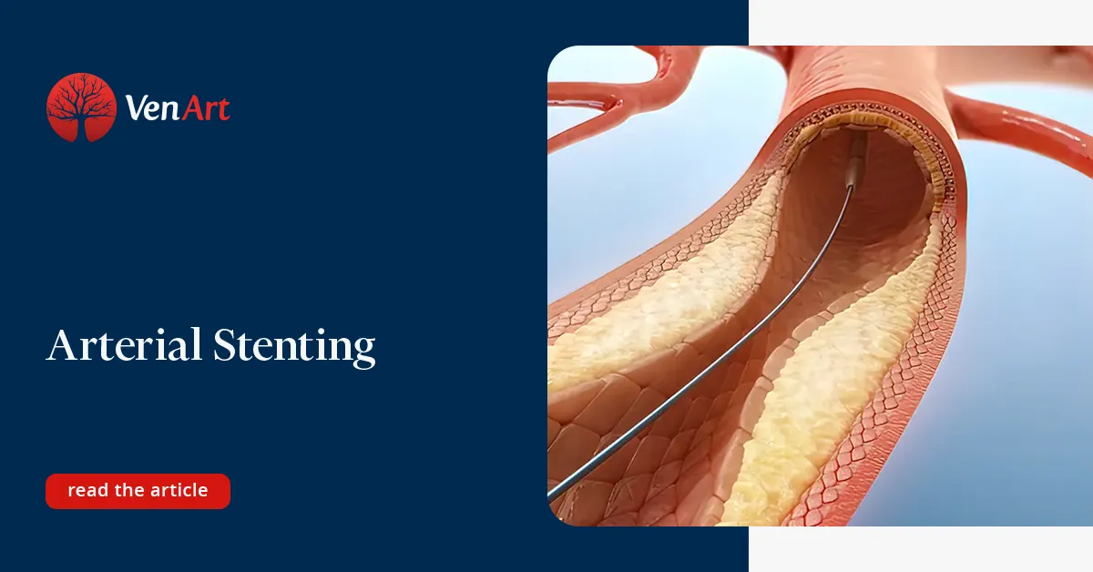 Arterial Stenting and Angioplasty: Benefits, Risks | VenArt Clinic