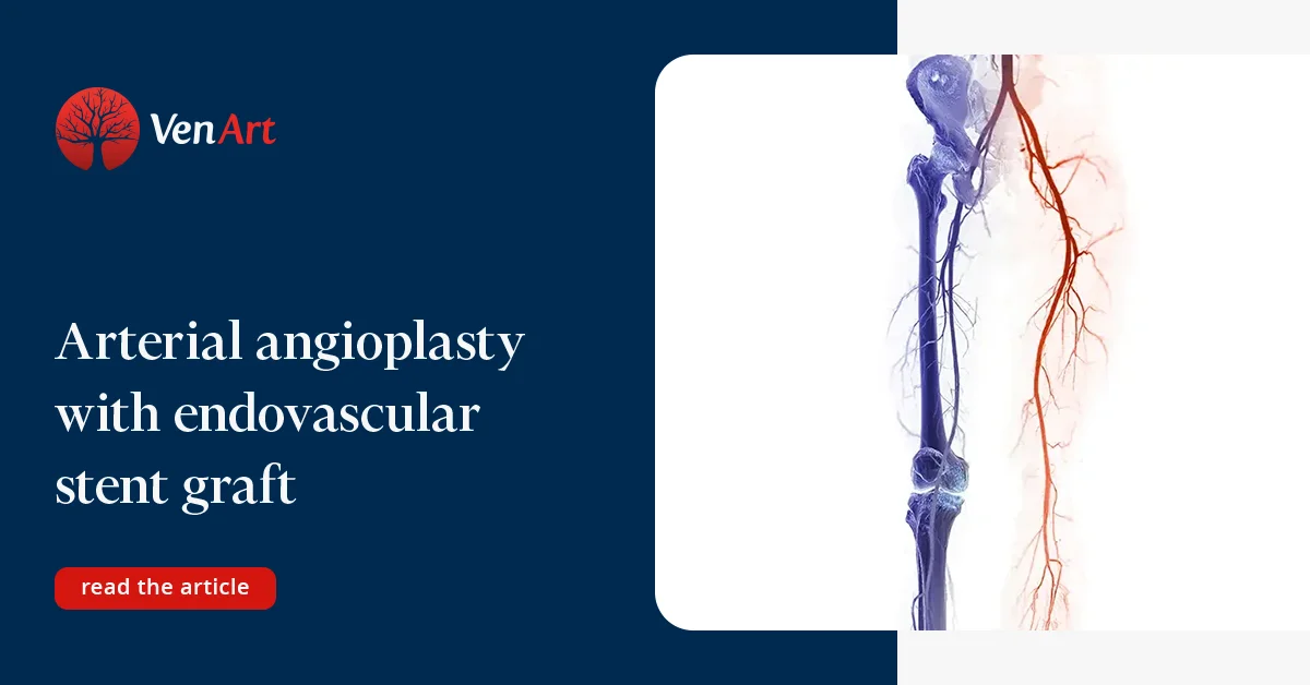 Peripheral Arterial Angioplasty with Stent Graft | VenArt Clinic