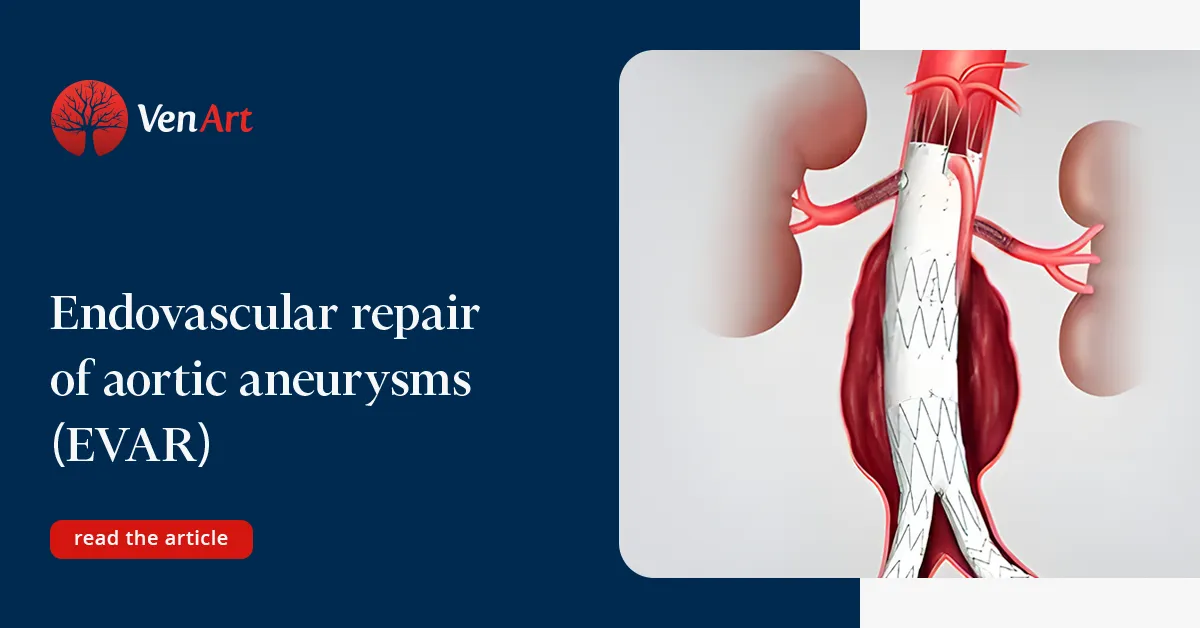 Endovascular Aortic Aneurysm Repair (EVAR) | VenArt Clinic