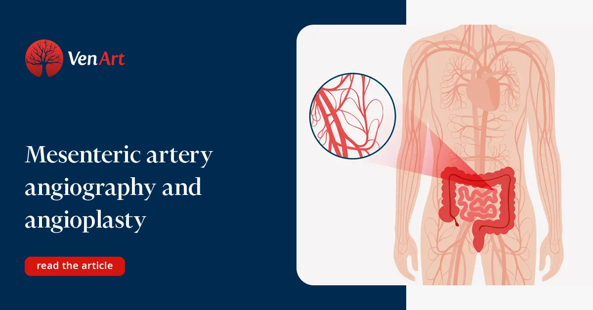 Mesenteric Artery Angiography and Angioplasty | VenArt Clinic