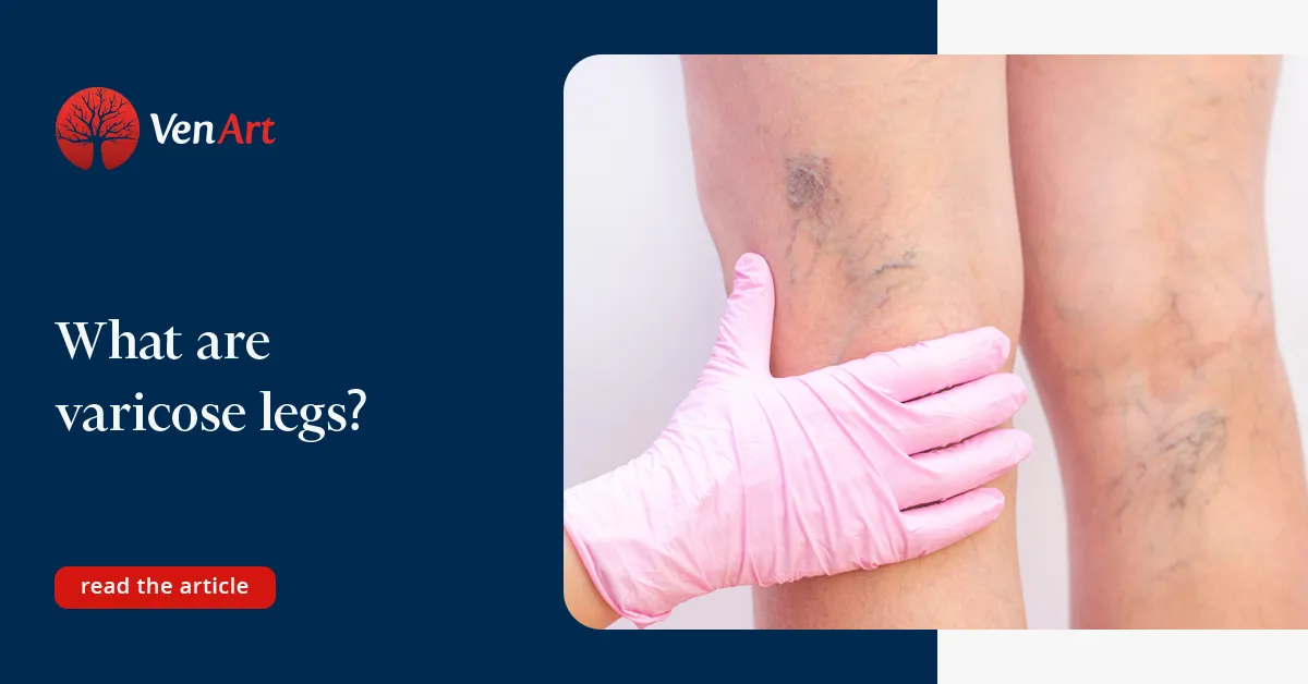 Varicose Legs: Causes, Symptoms & Treatments | VenArt Clinic