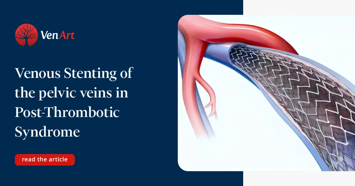 Venous Stenting of the Pelvic Veins in Post-Thrombotic Syndrome