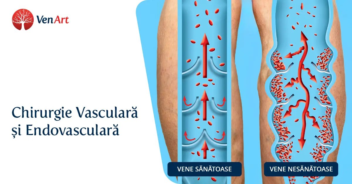 Chirurgie Vasculara - Boala Arteriala Periferica si Boala Venoasa