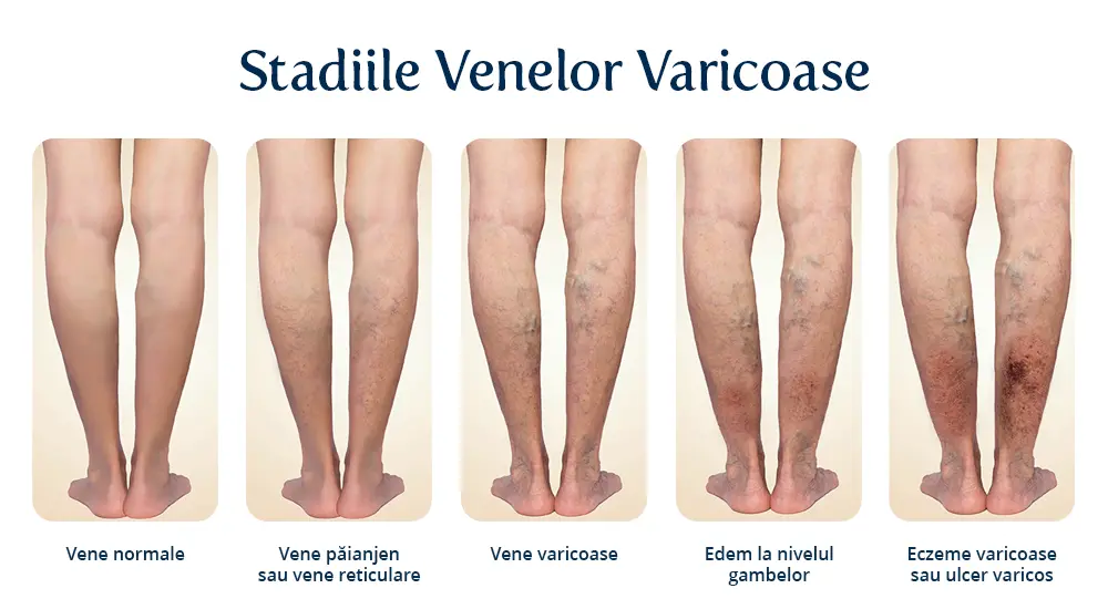 Ce sunt varicele la picioare?