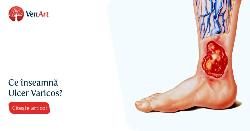 What Is a Venous Leg Ulcer? Causes, Symptoms & Treatment | VenArt Clinic