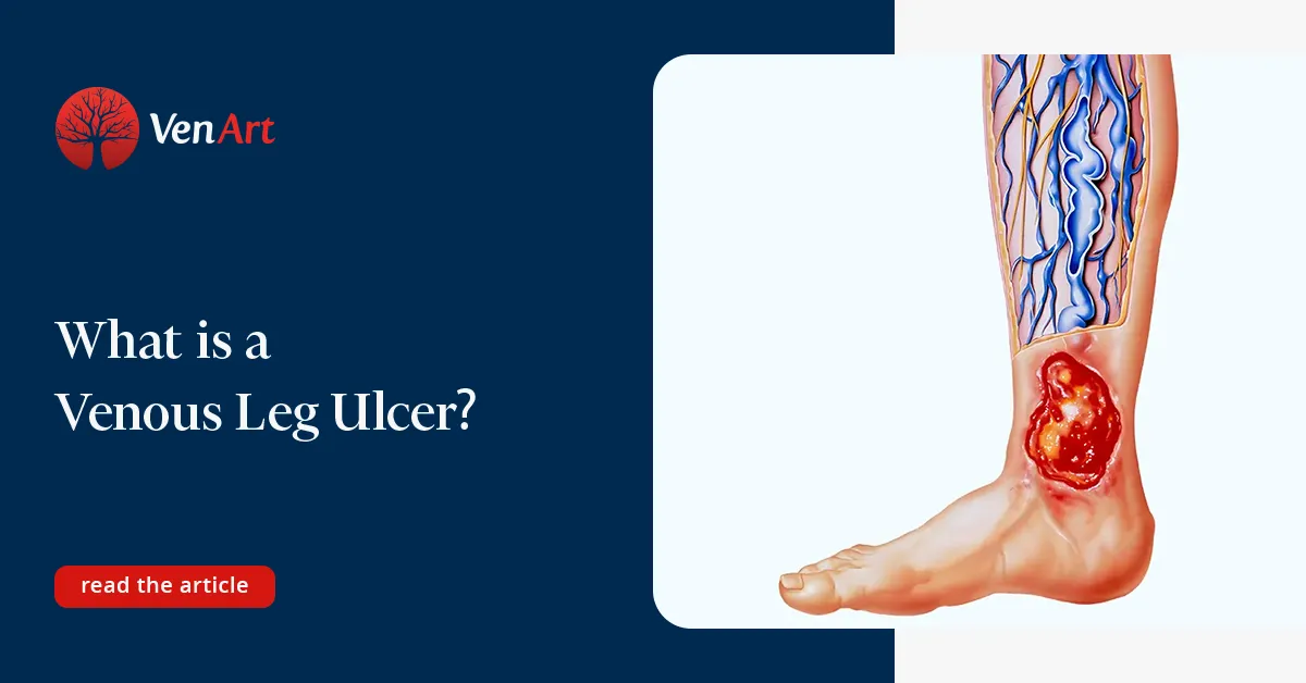 What Is a Venous Leg Ulcer? | VenArt Clinic