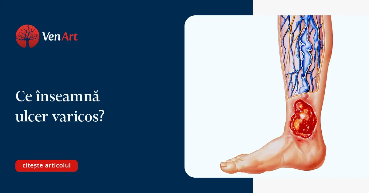 Ce inseamna ulcer varicos?