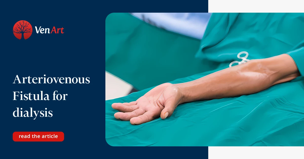 Arteriovenous fistula for dialysis | VenArt Clinic
