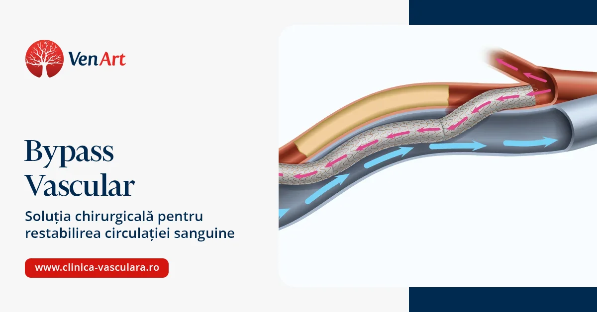 Bypass Vascular Cluj - Clinica VenArt