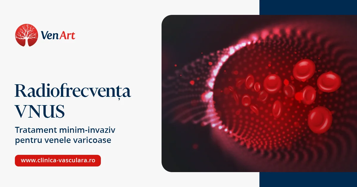 Radiofrecventa VNUS - Clinica VenArt