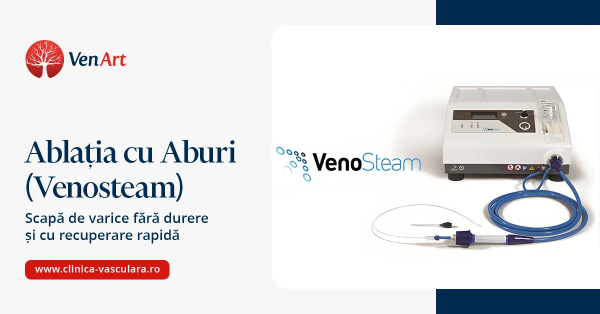 Ablația cu Aburi (Venosteam) | Tratament revoluționar pentru varice