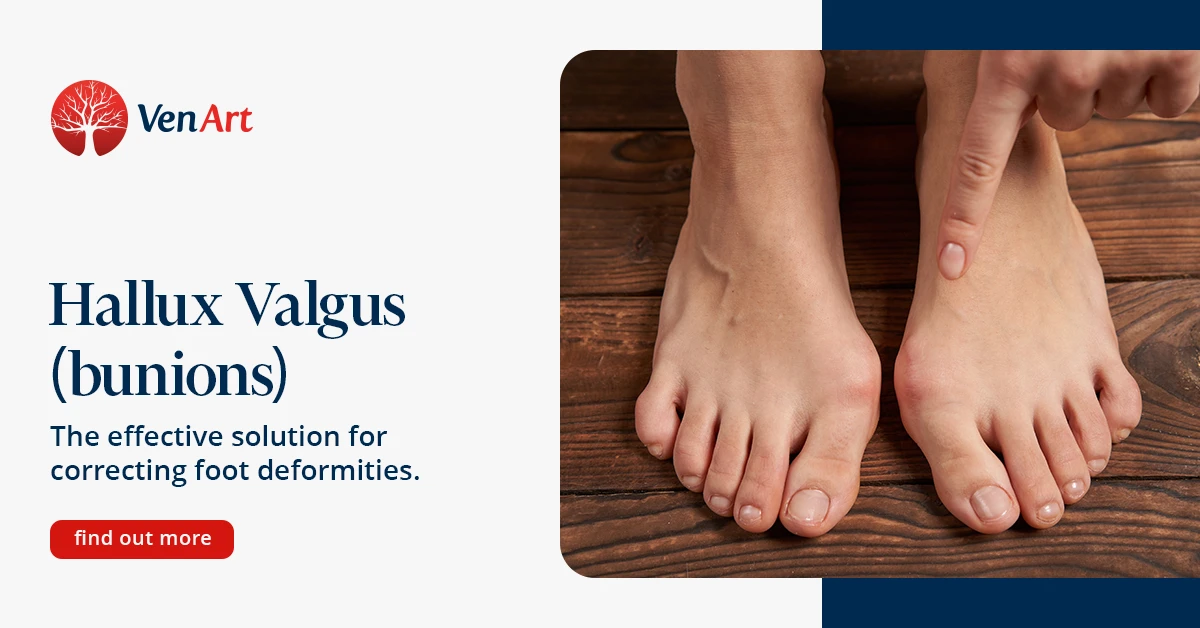 Hallux Valgus | Treatment at the VenArt Clinic in Cluj