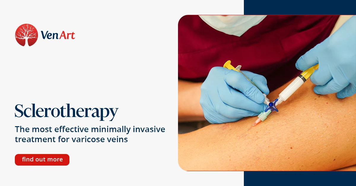 Sclerotherapy | Minimally Invasive Treatment for Varicose Veins