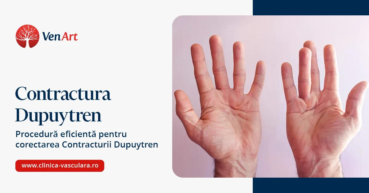 Contractura Dupuytren | Clinica VenArt